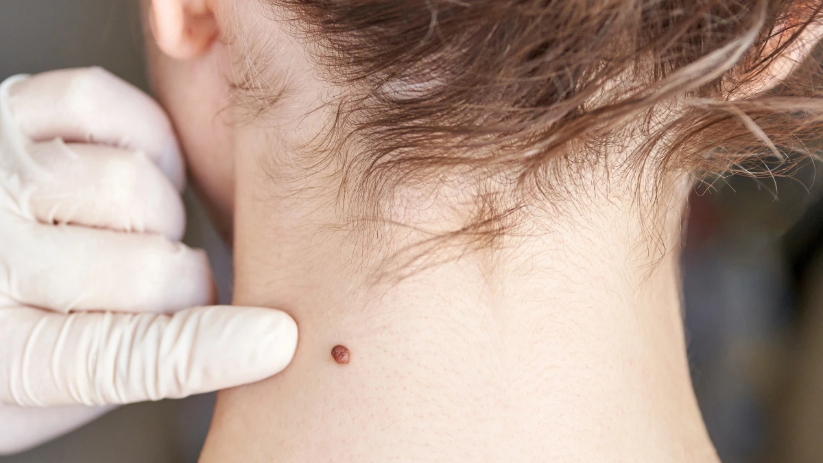 Verruga Filiforme No Rosto