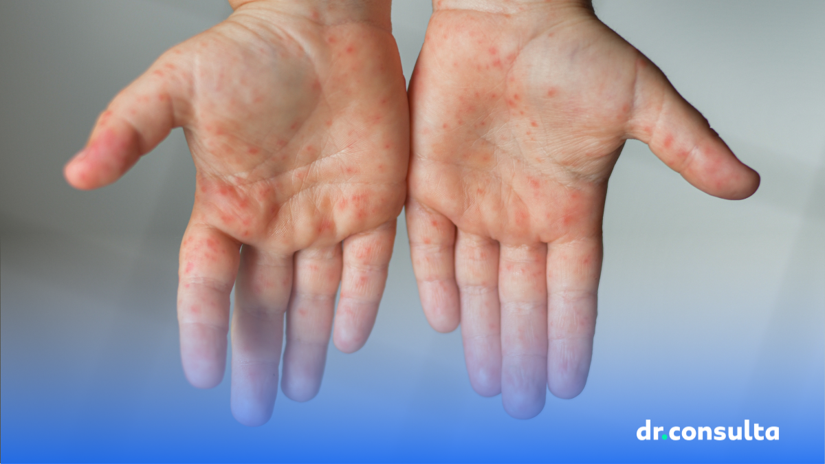 O que é a síndrome mão-pé-boca e como evitar | Blog dr.consulta