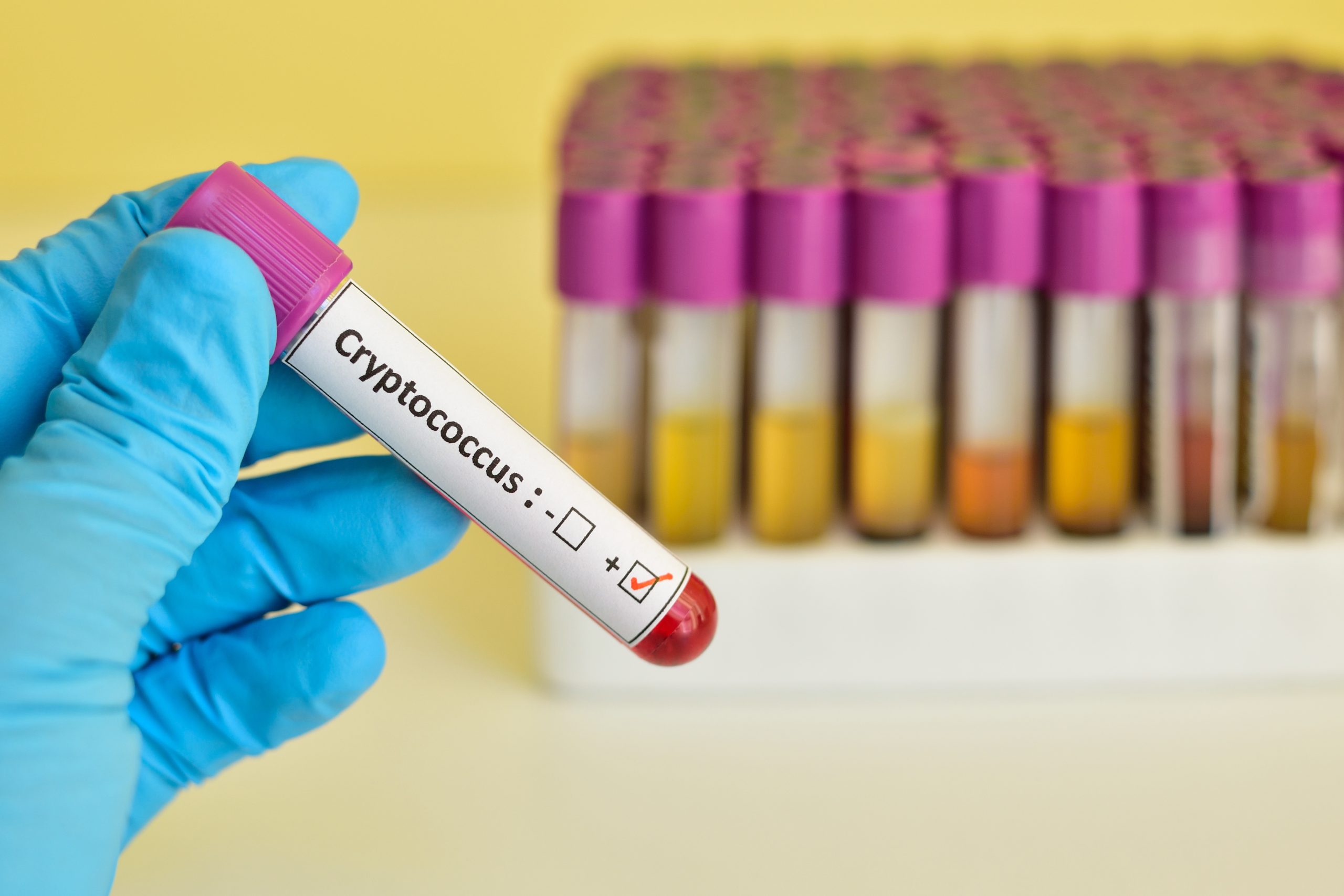 O que é criptococose? Conheça a doença do pombo | Blog dr.consulta