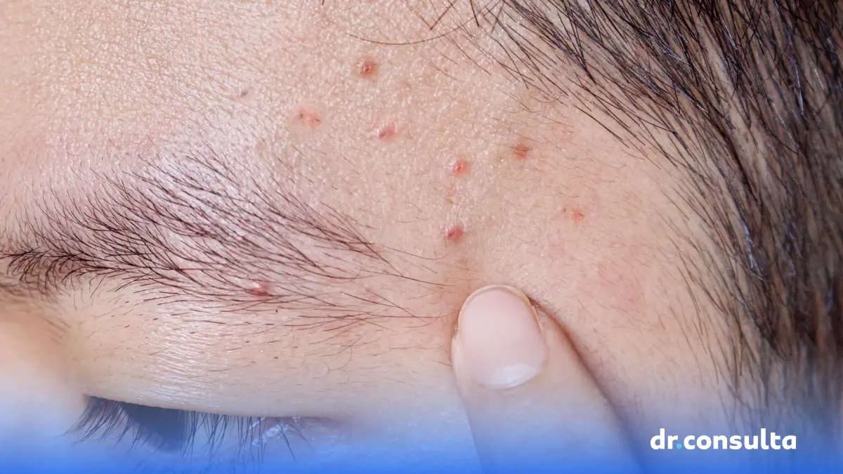 Como evitar a foliculite? Descubra 5 formas de prevenção | Blog dr.consulta