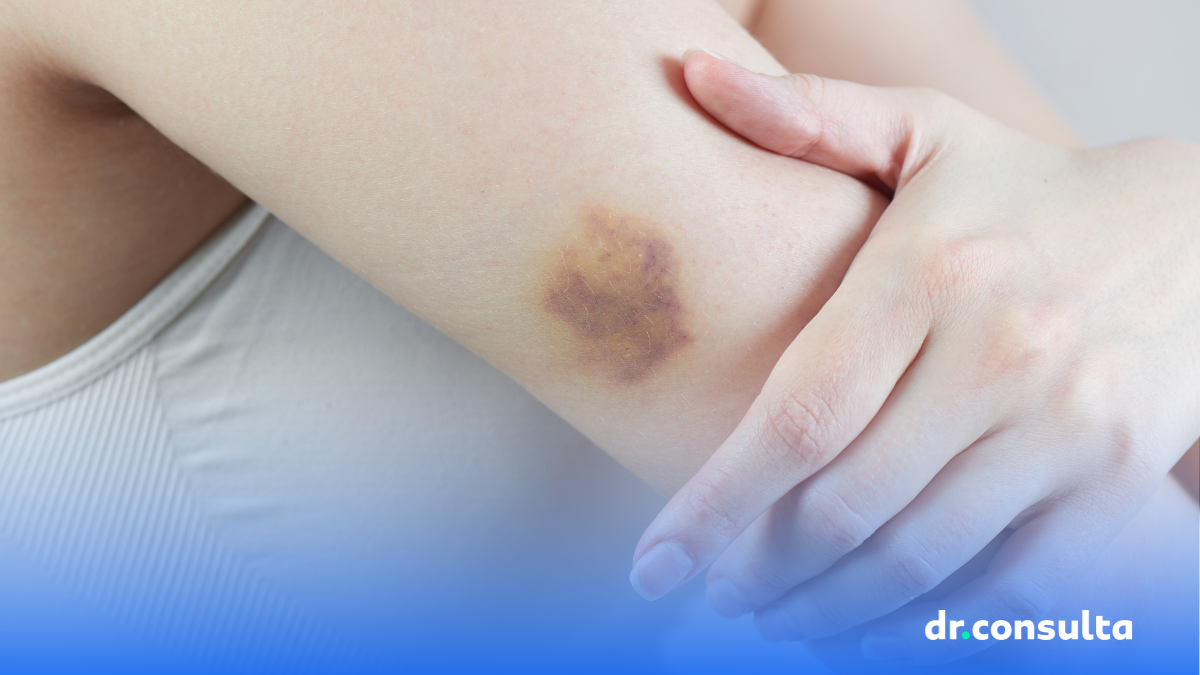 6 possíveis explicações para o surgimento de manchas roxas no corpo ...