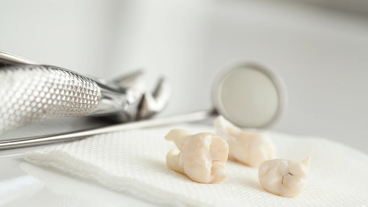 Exodontia: como funciona a extração de dentes | Blog dr.consulta